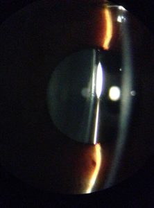 The ICL surgery procedure - Laserfocus Center for Eye Microsurgery